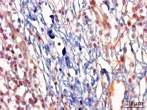 Immunohistochemistry Of The Skin Of Patients With Nonulcerated Or
