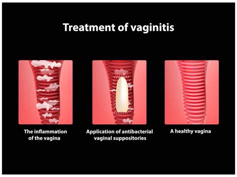 Vaginitis: Gejala, Penyebab, Pengobatan, dll - Hello Sehat