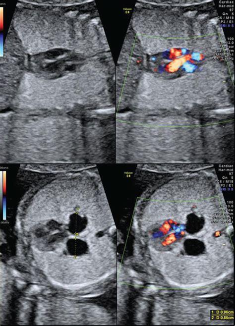 Small Centrally Placed And Compressed Heart By Large Echogenic Lungs