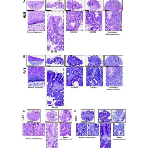 Siewert Classification Of Adenocarcinoma Of The Esophagogastric