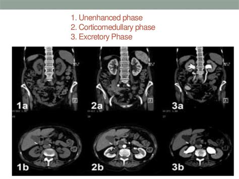 Ct Urography