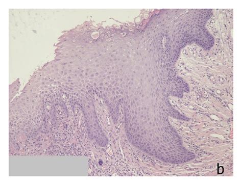 A Cytology Squamous Cells Thinprep Pap Stain ×400 B Download Scientific Diagram