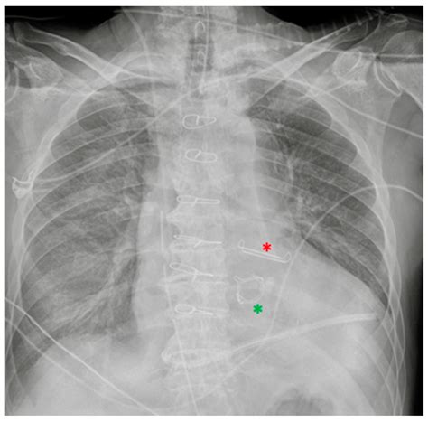 Intra Aortic Balloon Pump Xray