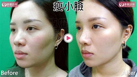女人知己試用大隊 部落客、網紅、kol口碑行銷平台 專家文章分享 肉毒桿菌瘦小臉不只定型還可以拉提