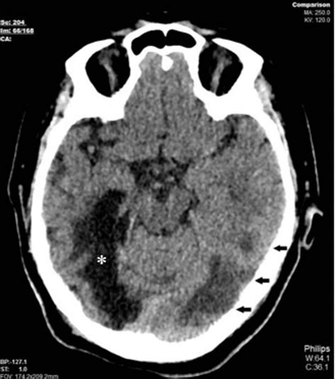 Ct Of The Brain In The Axial Plane Showed Ill Defined Hypodensities In Download Scientific