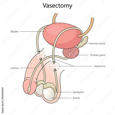 Vasectomy On The Male Reproductive System Highlighting Key Anatomical