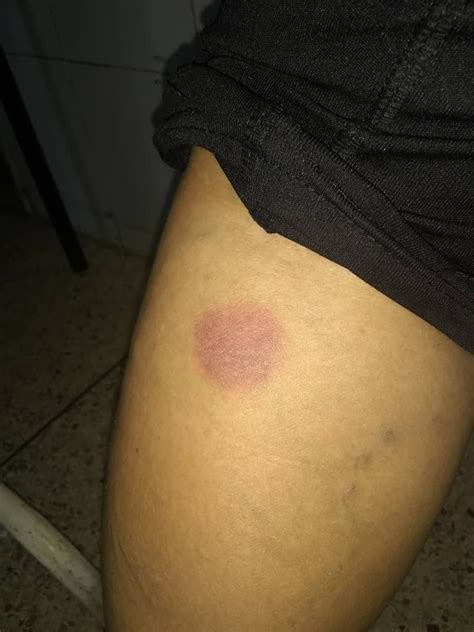 El RincÓn De La Medicina Interna Juanpedromacalusoar Casos
