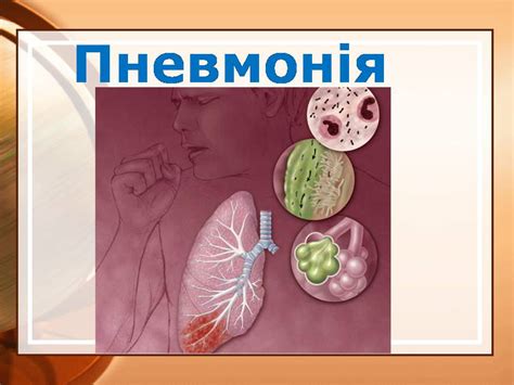 Презентація на тему Пневмонія — презентації з біології Gdz4you