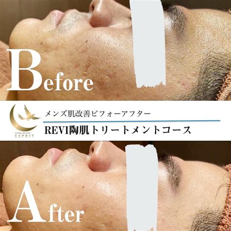 メンズハーブピーリングrevi陶肌トリートメント驚愕の結果がどんどん出ています エスプリニュース（詳細）｜東京銀座、新宿のエステサロン