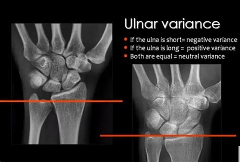 Ulnar Variance Radiology Imaging Radiology Bone Diseases