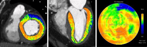 Myocardial Extracellular Volume Quantification With Computed Tomography—current Status And