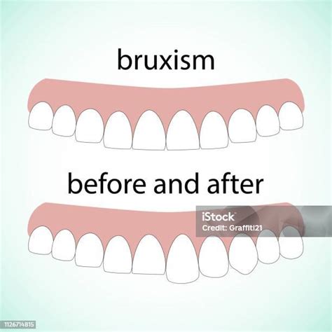레이아웃 소모전 Bruxism 치아 일러스트 벡터입니다 지워진된 치아입니다 치아의 복원입니다 치과 개념입니다 이갈이에 대한 스톡