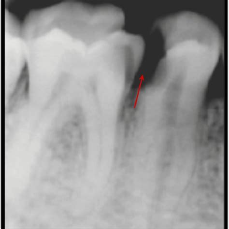 Preoperative View Depicting Distant Proximal Caries With 35 Download Scientific Diagram