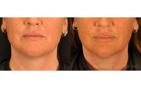 Botox Neuromodulators SONA MD