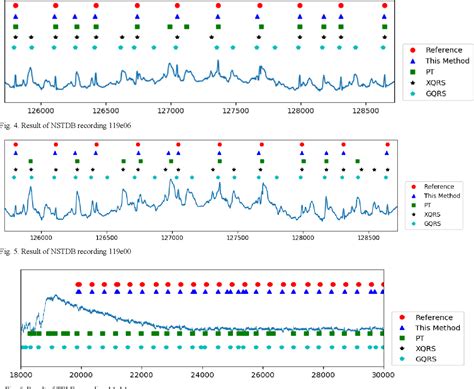Figure 4 From A Robust Qrs Detection Method Based On Adaptive