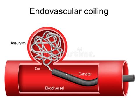 Endovascular Coiling Of Aneurysm Stock Illustration Illustration Of Cerebral Intracranial