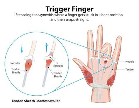 Free Vector Trigger Finger Medical Illustration