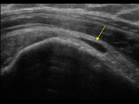 Musculoskeletal Joints And Tendons 6 1 Shoulder Case 6 1 17 Bursa