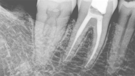 Apical Periodontitis And Pdl Widening How To Treat This Details In Comment R Askdentists