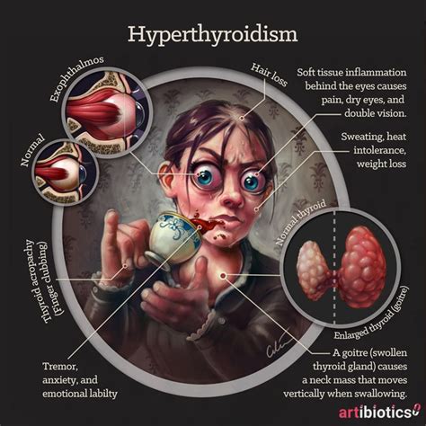 Pin On Hyperthyroidism And Hypothyroidism