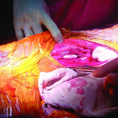 Patch Plasty Over Common Femoral Artery Download Scientific Diagram