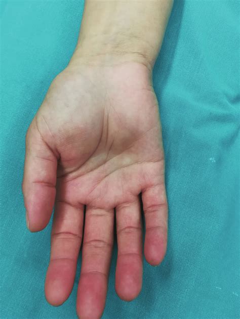 Clinical Image Of The Patients Right Palm A Soft Tissue Mass Of The Download Scientific