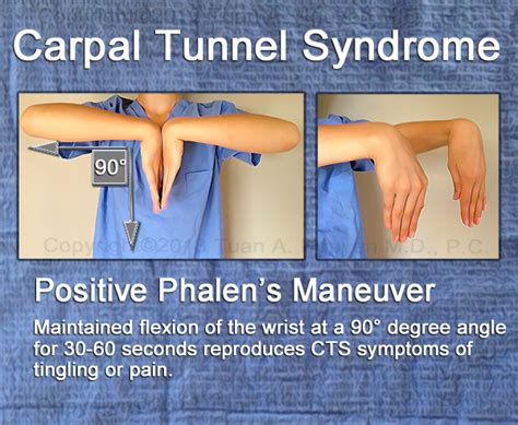 Diagnosis And Testing For Carpal Tunnel Syndrome Portland Hand Surgery