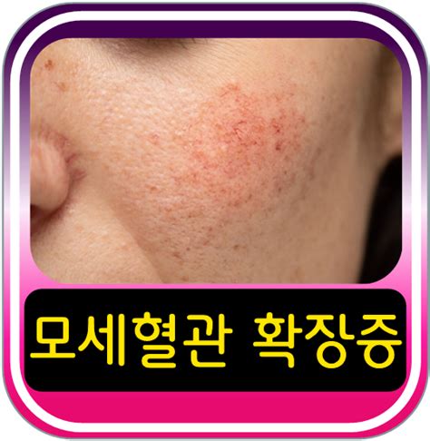 모세혈관확장증 원인 증상 치료방법 예방법 네이버 블로그