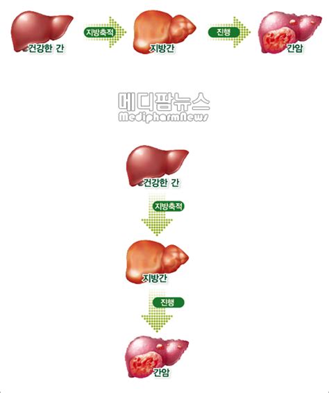간경화 생명 위협하는 시한폭탄