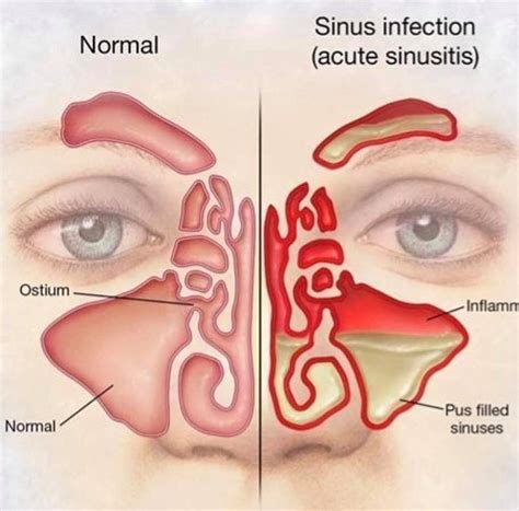 Sinusitis Is An Inflammation Or Swelling Of The Tissue Lining The