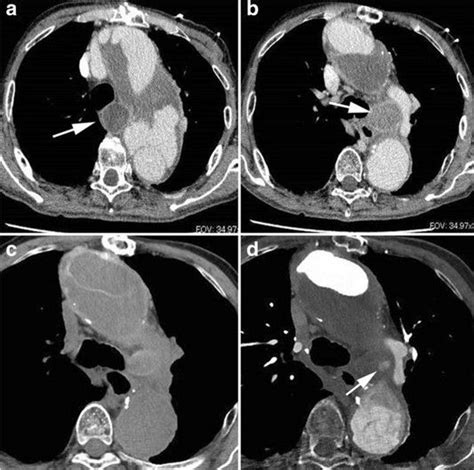 Cvir Endovascular On Linkedin Massive Hemoptysis Is A Life Threatening