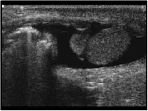 Pediatrics 93 Pediatric Scrotum Case 932 Scrotal Hernias