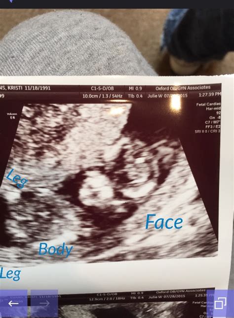 13 Week Ultrasound Glow Community