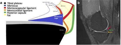 Variability Of The Posteromedial Meniscocapsular Junction Of The Knee