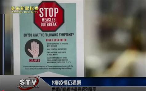 全美10年來第1例！ 德州通報麻疹死亡個案 美南新聞 全美最大亞裔多媒體集團