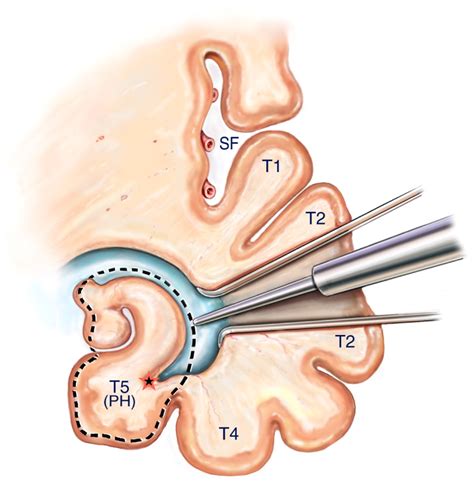 Medial Temporal Lobe Epilepsy
