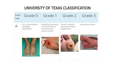 Diabetic Foot Ulcer Classification System Texa S And Wagner Pptx
