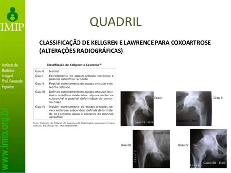 Osteoartrose Ac Basico