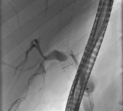 Ercp Image Demonstrating The Stricture Non Filling Portion And
