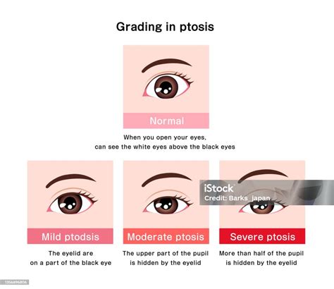 Grading Dalam Ilustrasi Vektor Ptosis Ilustrasi Stok Unduh Gambar