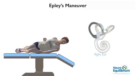 Bppv Treatment Epley Maneuver Viral Sexiz Pix The Best Porn Website