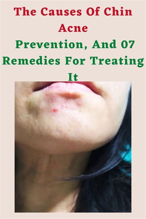 The Causes Of Chin Acne Prevention And 07 Remedies For Treating It