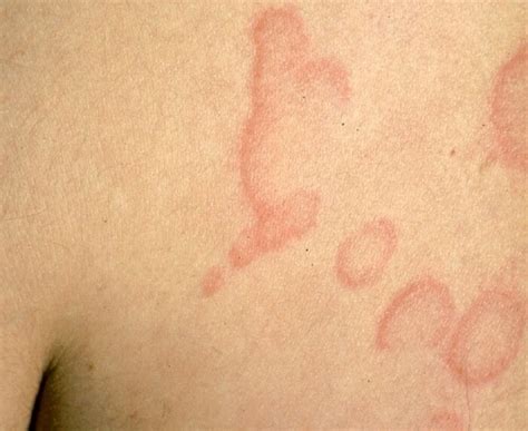 Alergias Dermatológicas Dr Daudén Dermatología