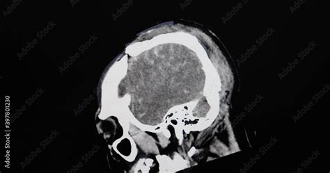 Ct Cine Scan Of A Patient With Falling Injury Showing Severe Depression