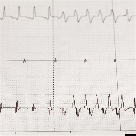 ECG On The Go Hackaday Io