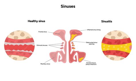 Sinuses Anatomy Healthy Sinus And Sinusitis Nose Nasal Anatomy