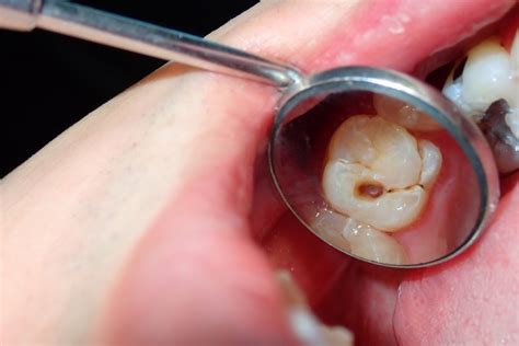 Blog Da Maisdental Planos Odontológicos