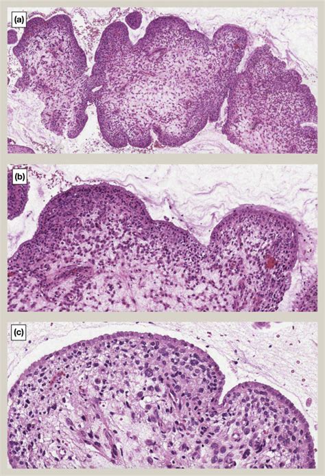 Uterine Adenosarcoma A Case Based Review Of The Diagnostic Features Diagnostic Histopathology