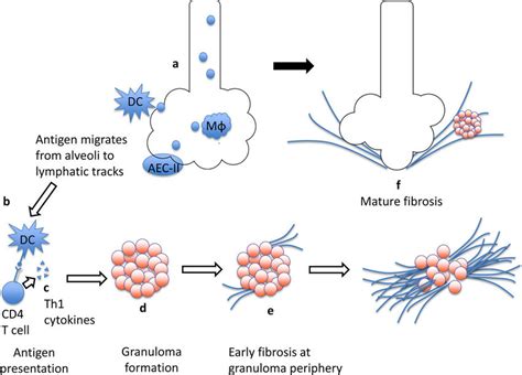 Chronic Granulomatous Disease Pathophysiology