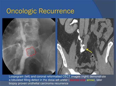 Ppt Multi Modality Imaging Of Urinary Diversion Complications